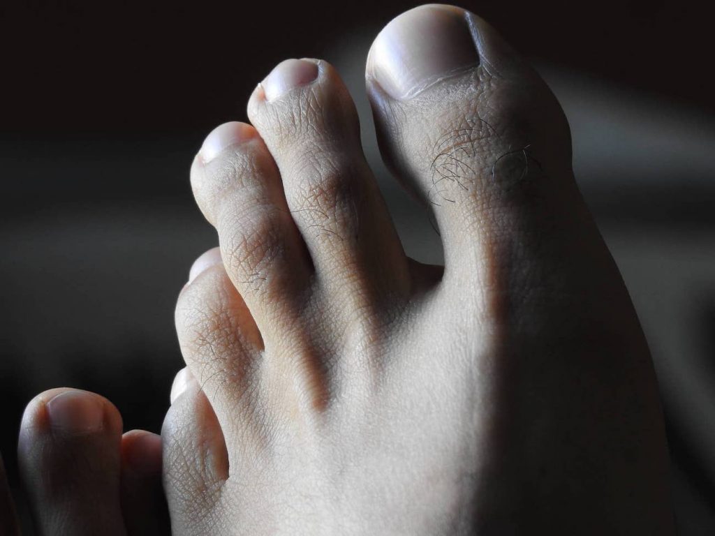 Can I Remove Minor Calluses From My Feet? | Jaws Podiatry