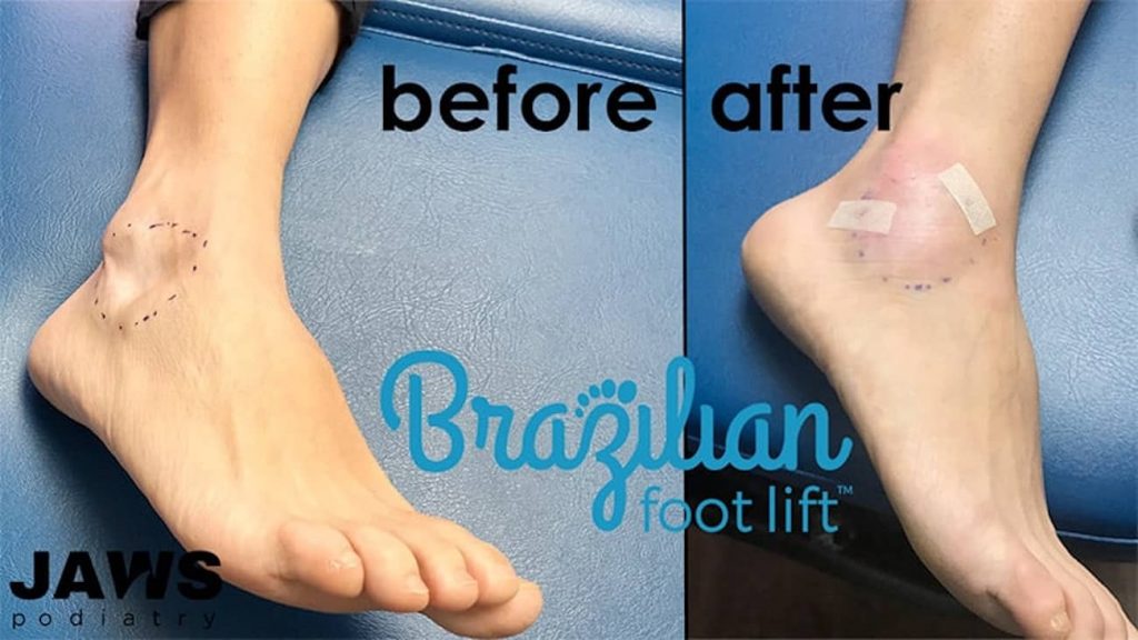 The Brazilian Foot Lift - Non-Surgical Relief From Foot Pain