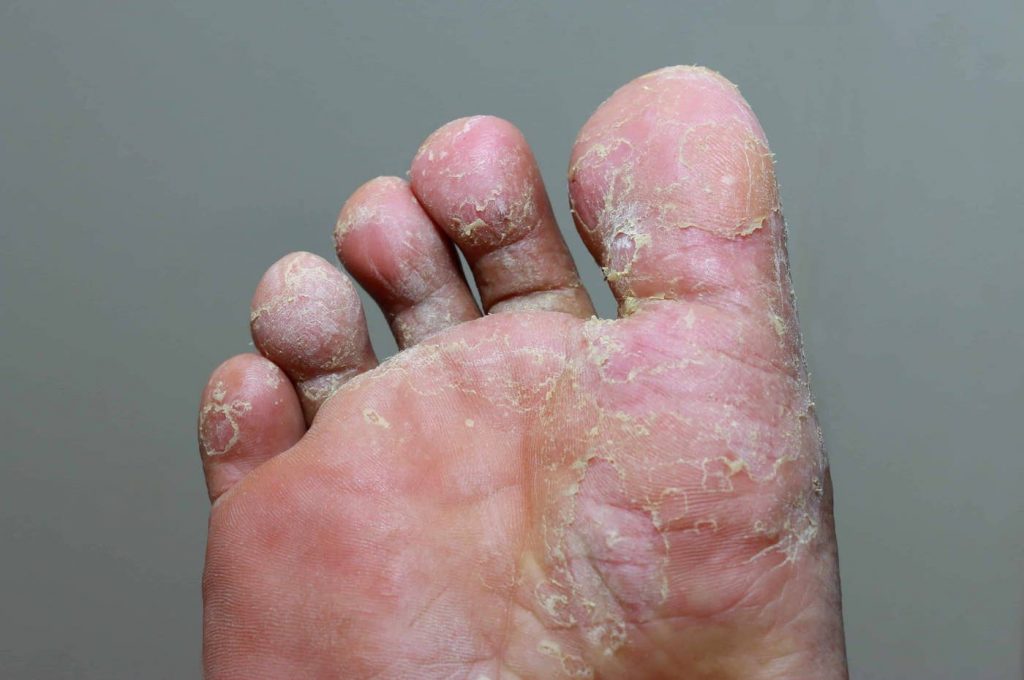 The Types of Fungal Foot Infections - A Podiatrist's Guide