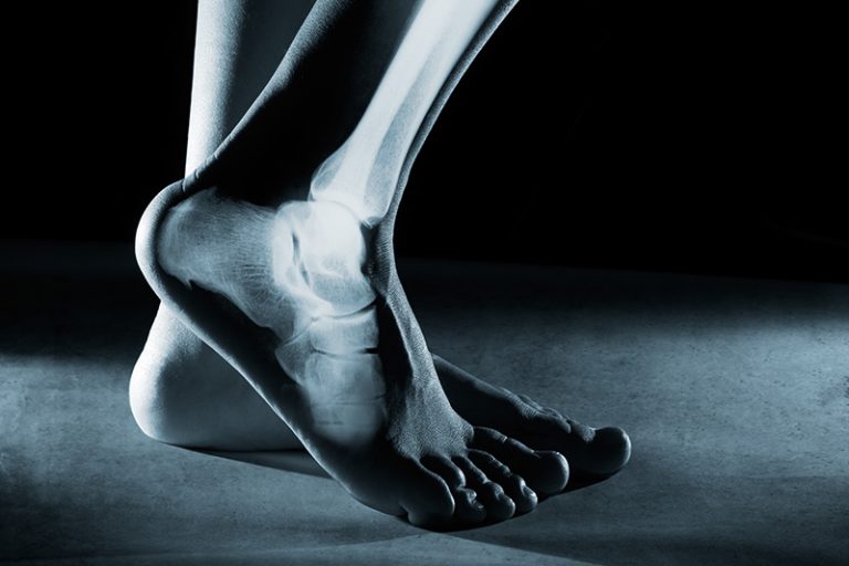 6 Benefits of Minimally-Invasive Foot and Ankle Surgery