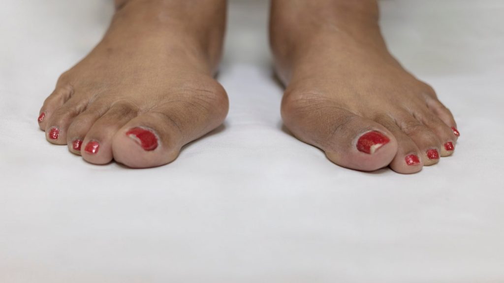 What Causes Bunions And Why Are They So Common?
