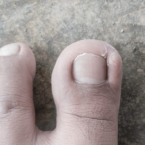 A Podiatrist's Guide To Wart and Ingrown Toenail Removal